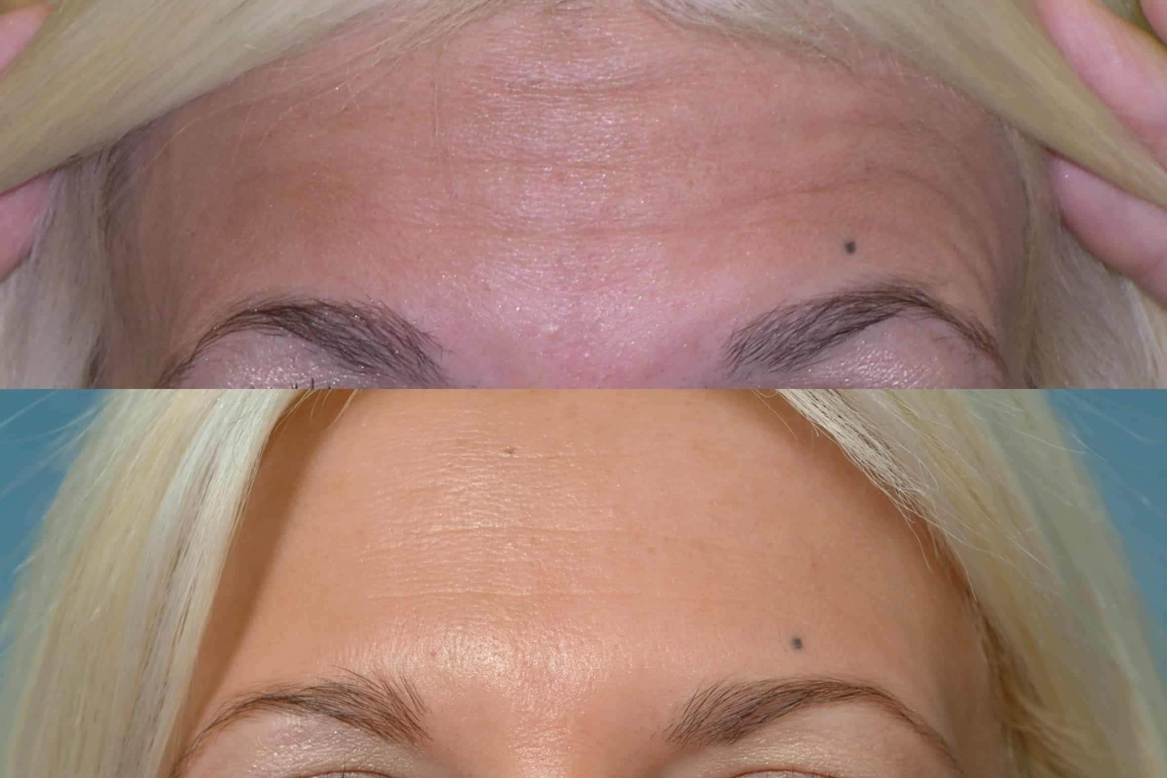 Botox Archives - Envee Aesthetics